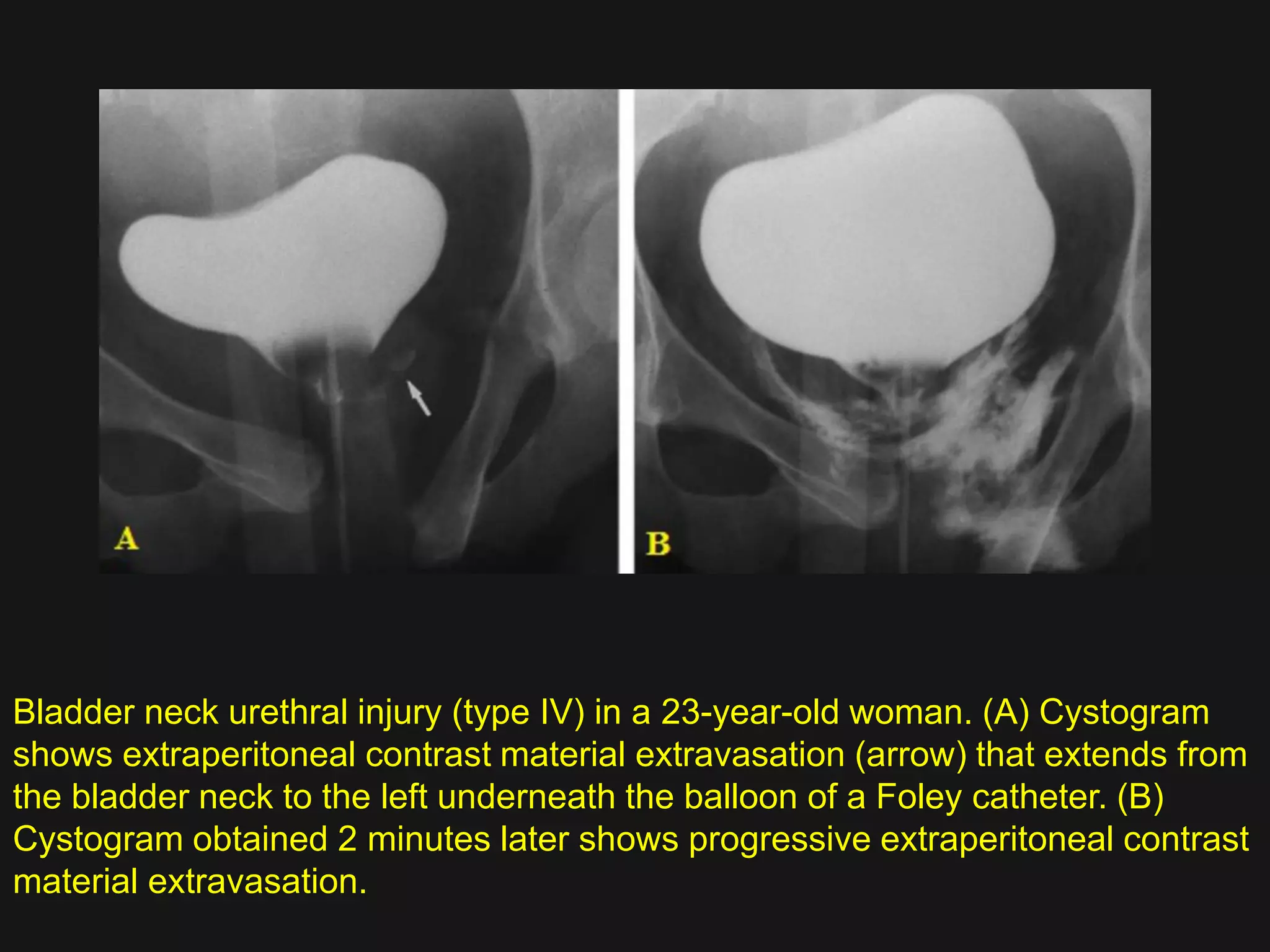Imaging abdomen trauma urethra trauma part 9 Dr Ahmed Esawy | PPT