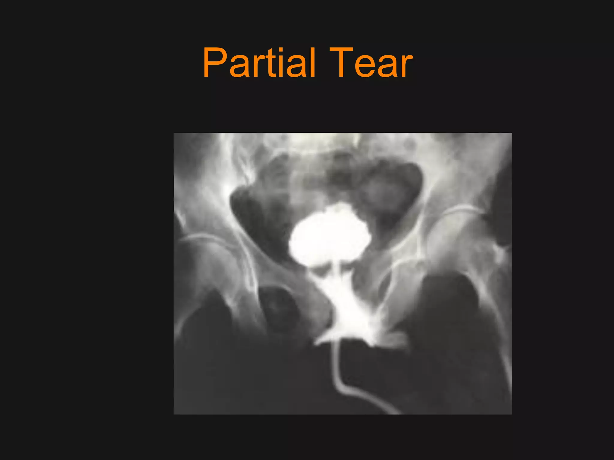 Imaging abdomen trauma urethra trauma part 9 Dr Ahmed Esawy | PPT
