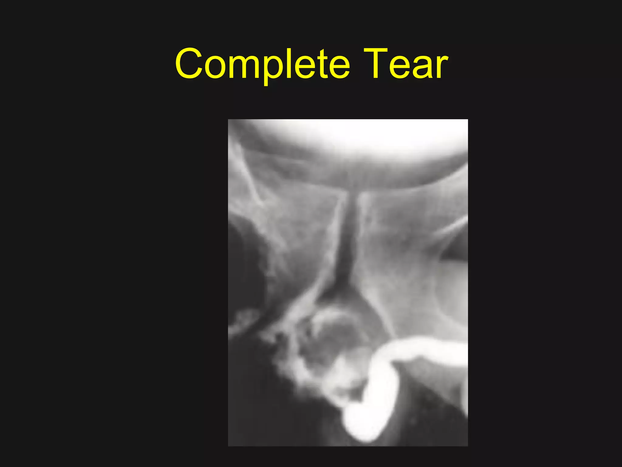 Imaging abdomen trauma urethra trauma part 9 Dr Ahmed Esawy | PPT