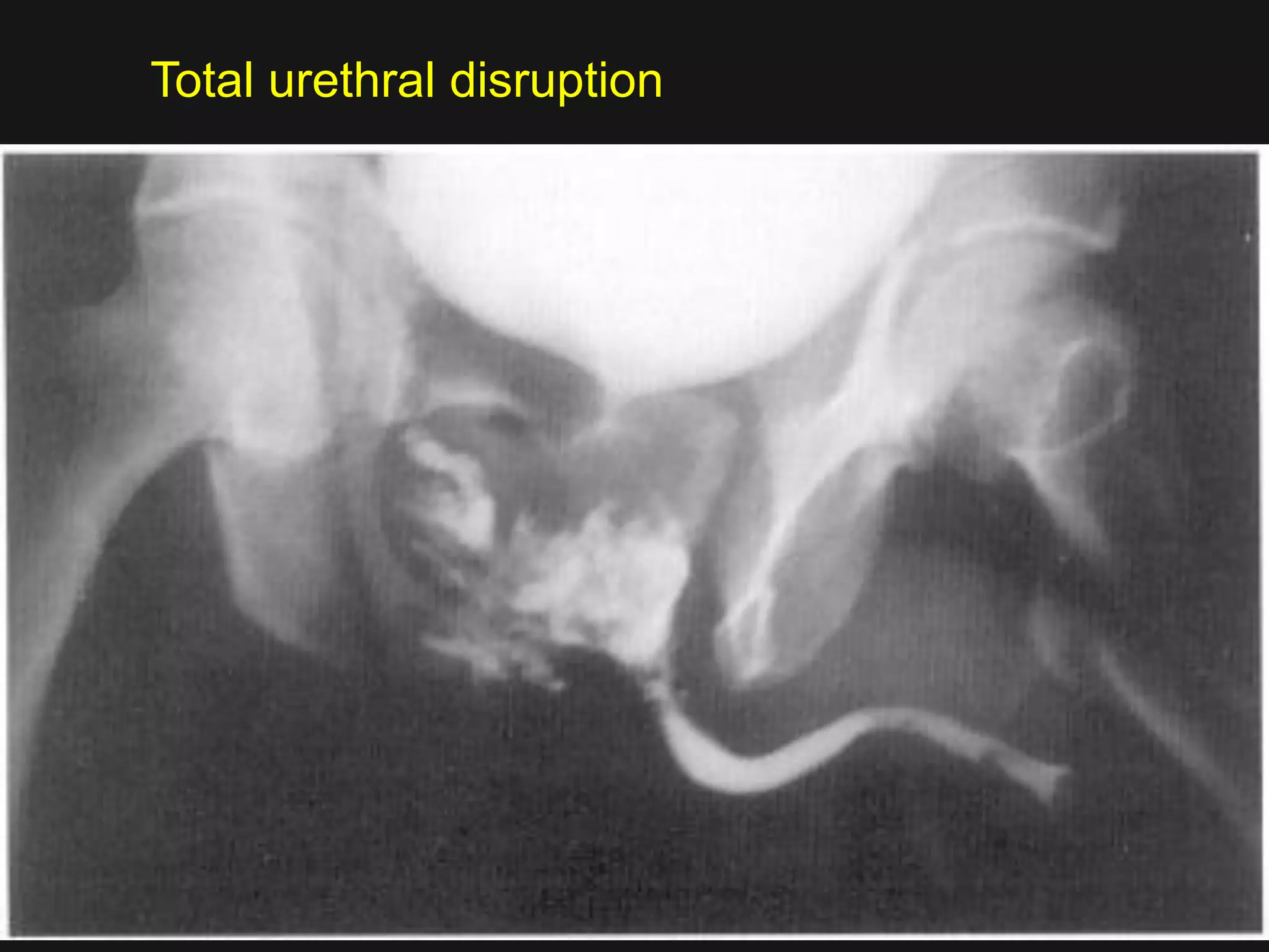 Imaging abdomen trauma urethra trauma part 9 Dr Ahmed Esawy | PPT