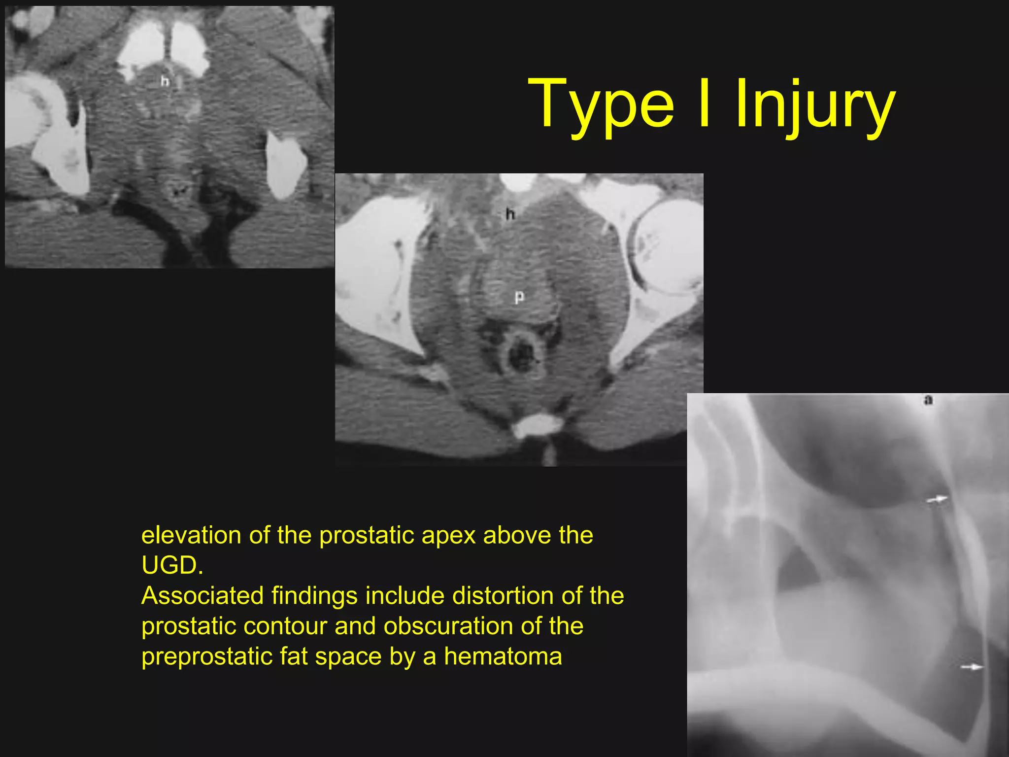 Imaging abdomen trauma urethra trauma part 9 Dr Ahmed Esawy | PPT
