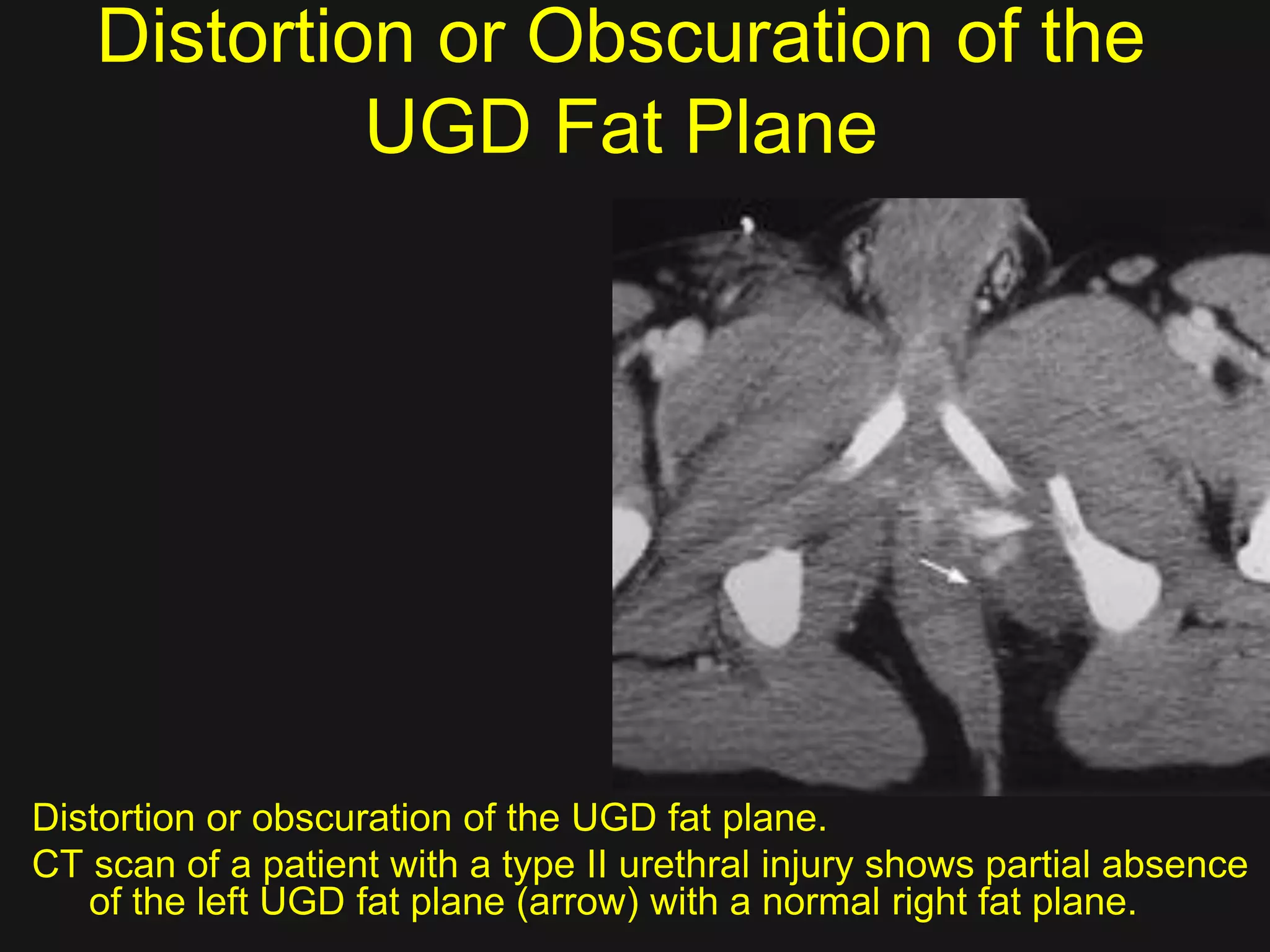 Imaging abdomen trauma urethra trauma part 9 Dr Ahmed Esawy | PPT