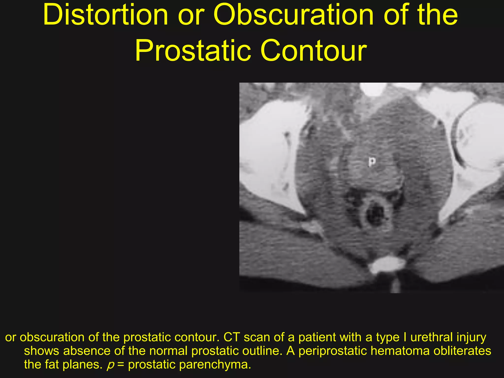 Imaging abdomen trauma urethra trauma part 9 Dr Ahmed Esawy | PPT