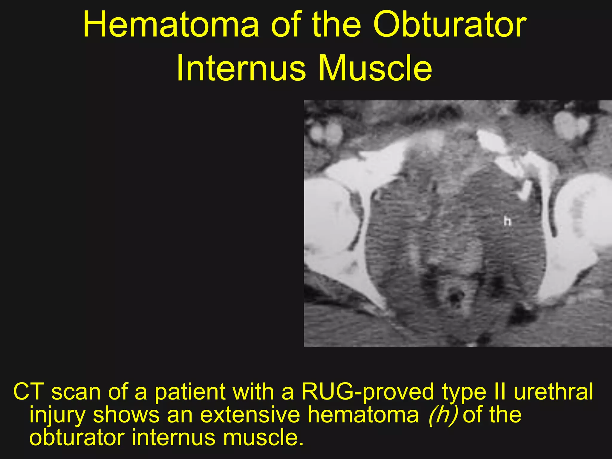 Imaging abdomen trauma urethra trauma part 9 Dr Ahmed Esawy | PPT