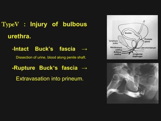 Imaging abdomen trauma urethra trauma part 9 Dr Ahmed Esawy | PPT