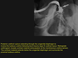 Imaging abdomen trauma urethra trauma part 9 Dr Ahmed Esawy | PPT