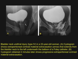 Imaging abdomen trauma urethra trauma part 9 Dr Ahmed Esawy | PDF