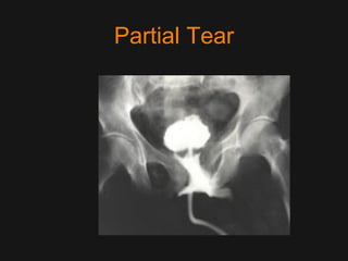 Imaging abdomen trauma urethra trauma part 9 Dr Ahmed Esawy | PDF