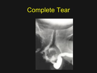 Imaging abdomen trauma urethra trauma part 9 Dr Ahmed Esawy | PDF