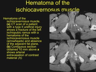 Imaging abdomen trauma urethra trauma part 9 Dr Ahmed Esawy | PDF