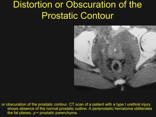 Imaging abdomen trauma urethra trauma part 9 Dr Ahmed Esawy | PPT