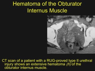 Imaging abdomen trauma urethra trauma part 9 Dr Ahmed Esawy | PDF