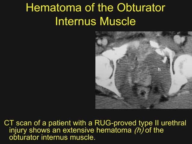 Imaging abdomen trauma urethra trauma part 9 Dr Ahmed Esawy | PPT