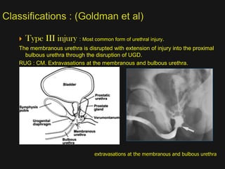 Imaging abdomen trauma urethra trauma part 9 Dr Ahmed Esawy | PDF