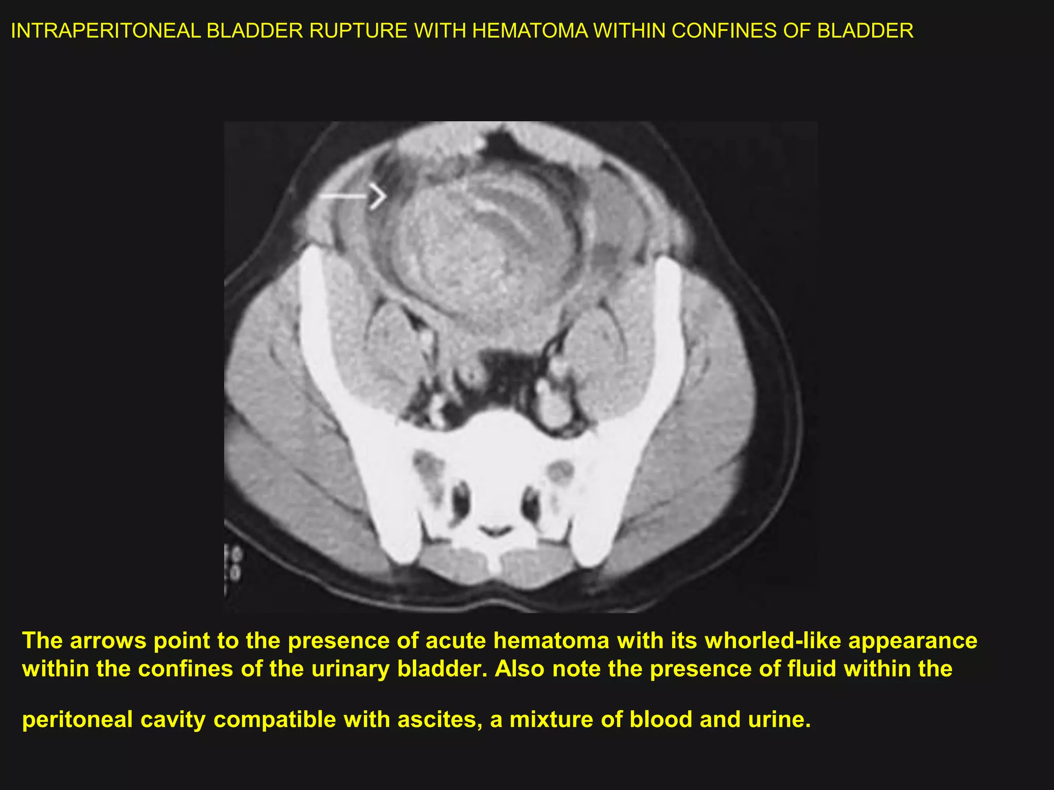 Imaging abdomen trauma urinary bladder ,trauma part 8 Dr Ahmed Esawy | PPT