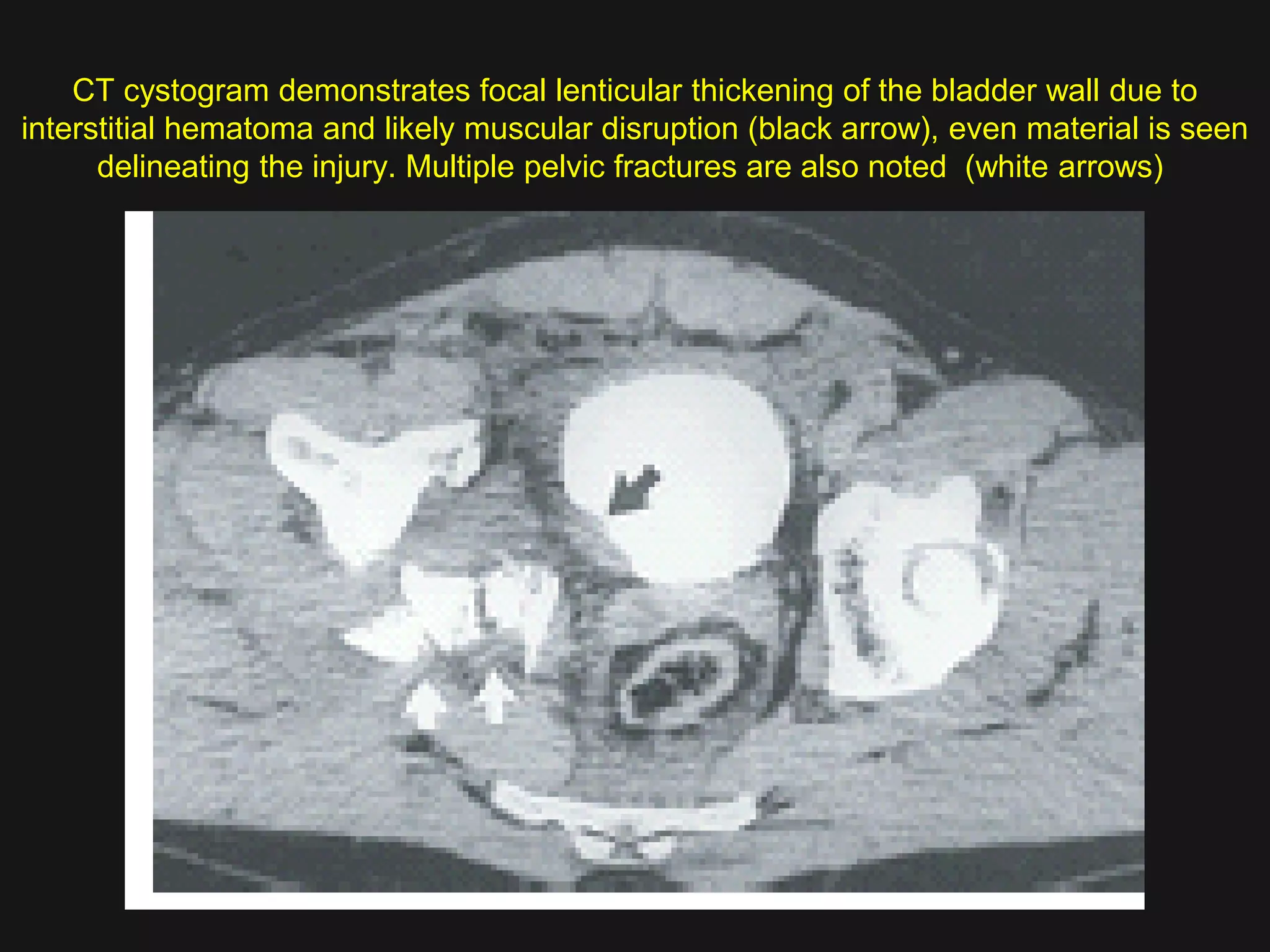 Imaging abdomen trauma urinary bladder ,trauma part 8 Dr Ahmed Esawy | PPT