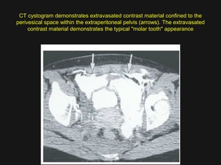 Imaging abdomen trauma urinary bladder ,trauma part 8 Dr Ahmed Esawy ...