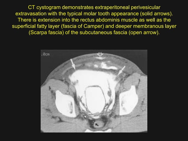 Imaging abdomen trauma urinary bladder ,trauma part 8 Dr Ahmed Esawy ...