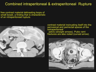 Imaging abdomen trauma urinary bladder ,trauma part 8 Dr Ahmed Esawy ...