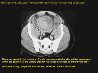 Imaging abdomen trauma urinary bladder ,trauma part 8 Dr Ahmed Esawy | PDF