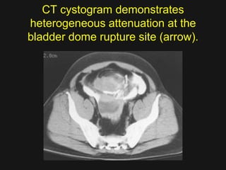Imaging abdomen trauma urinary bladder ,trauma part 8 Dr Ahmed Esawy ...