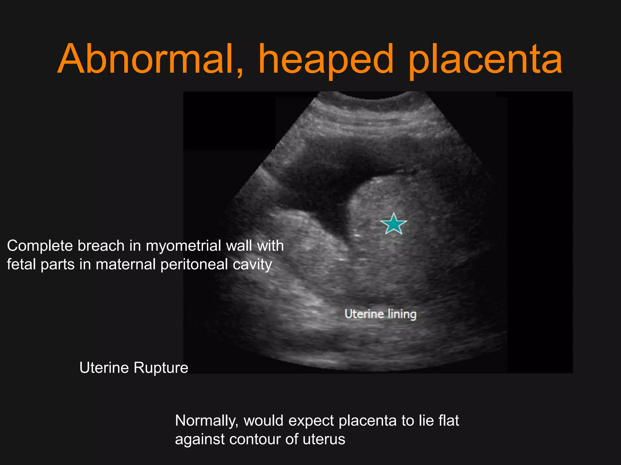 Imaging abdomen trauma uterine trauma part 11 Dr Ahmed Esawy | PDF
