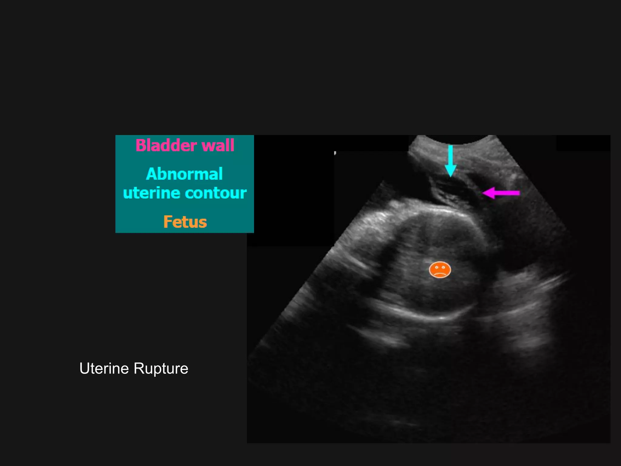 Imaging abdomen trauma uterine trauma part 11 Dr Ahmed Esawy | PDF