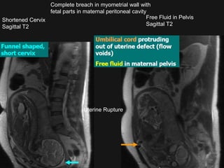 Imaging abdomen trauma uterine trauma part 11 Dr Ahmed Esawy | PDF