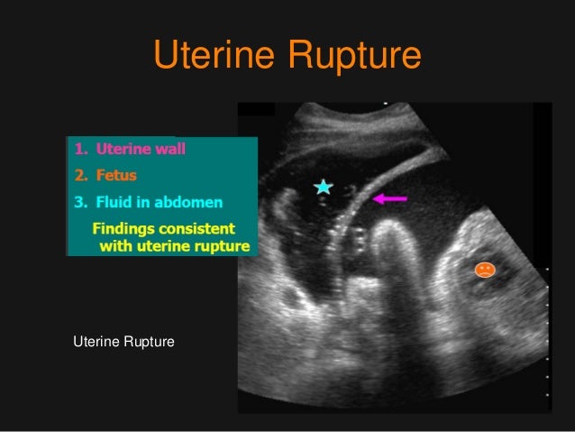Complete Rupture Of Uterus