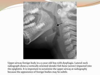 Epiglottis Xray