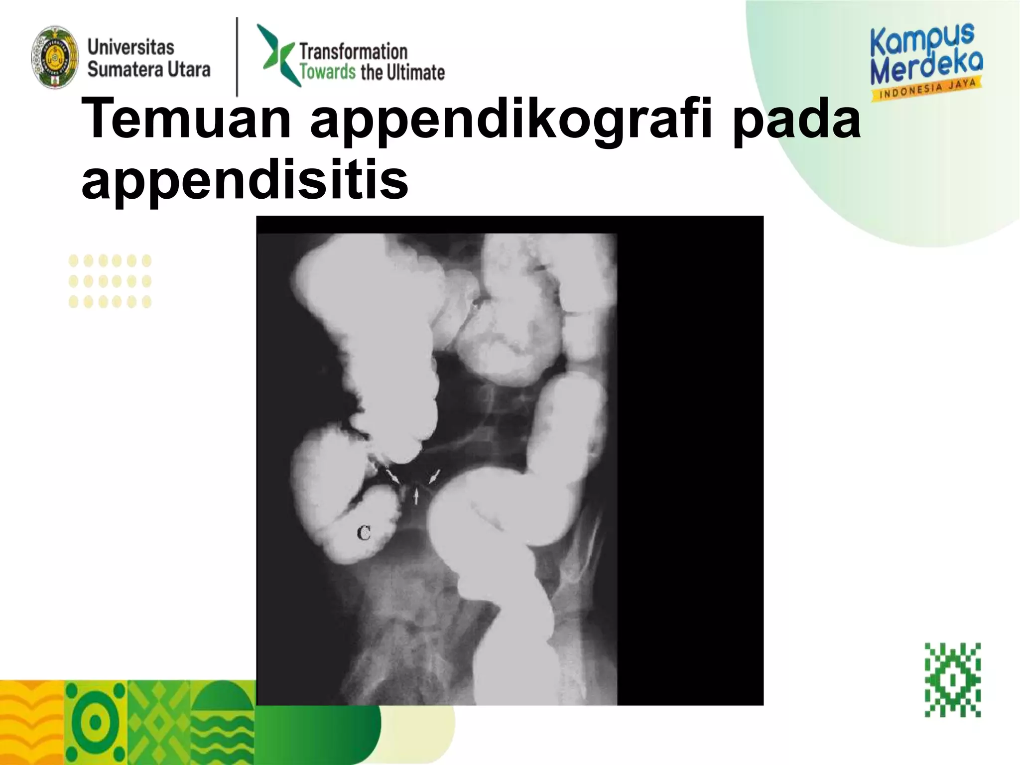 imaging acute appendicitisss.ppt