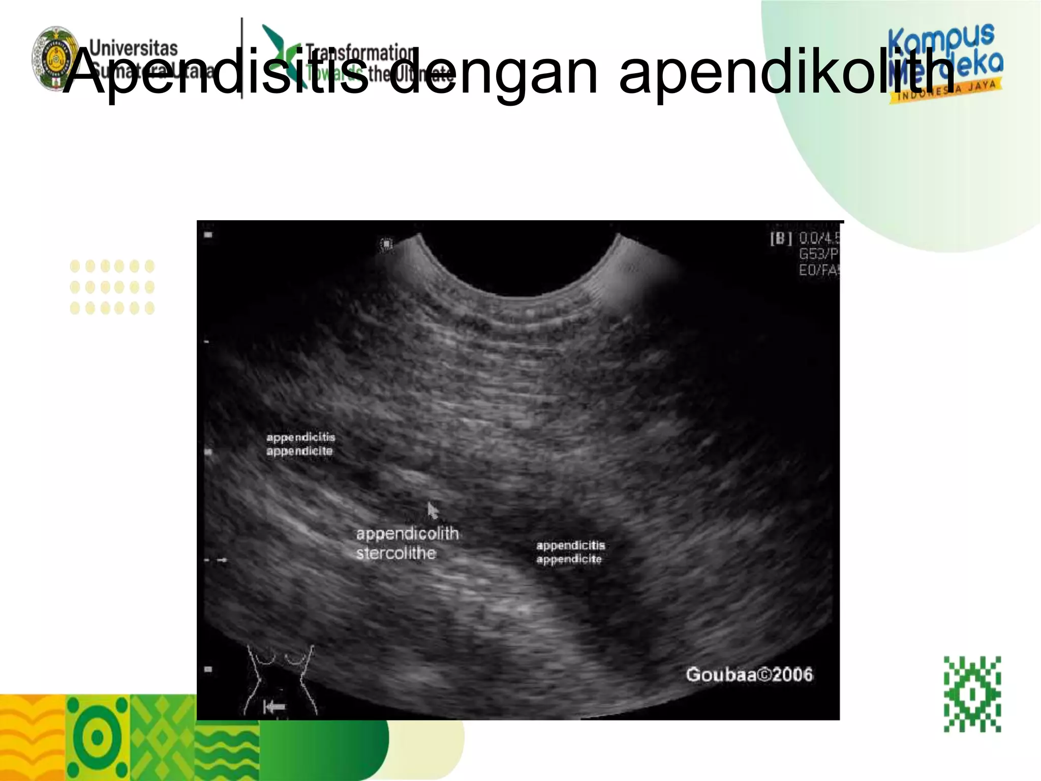 imaging acute appendicitisss.ppt