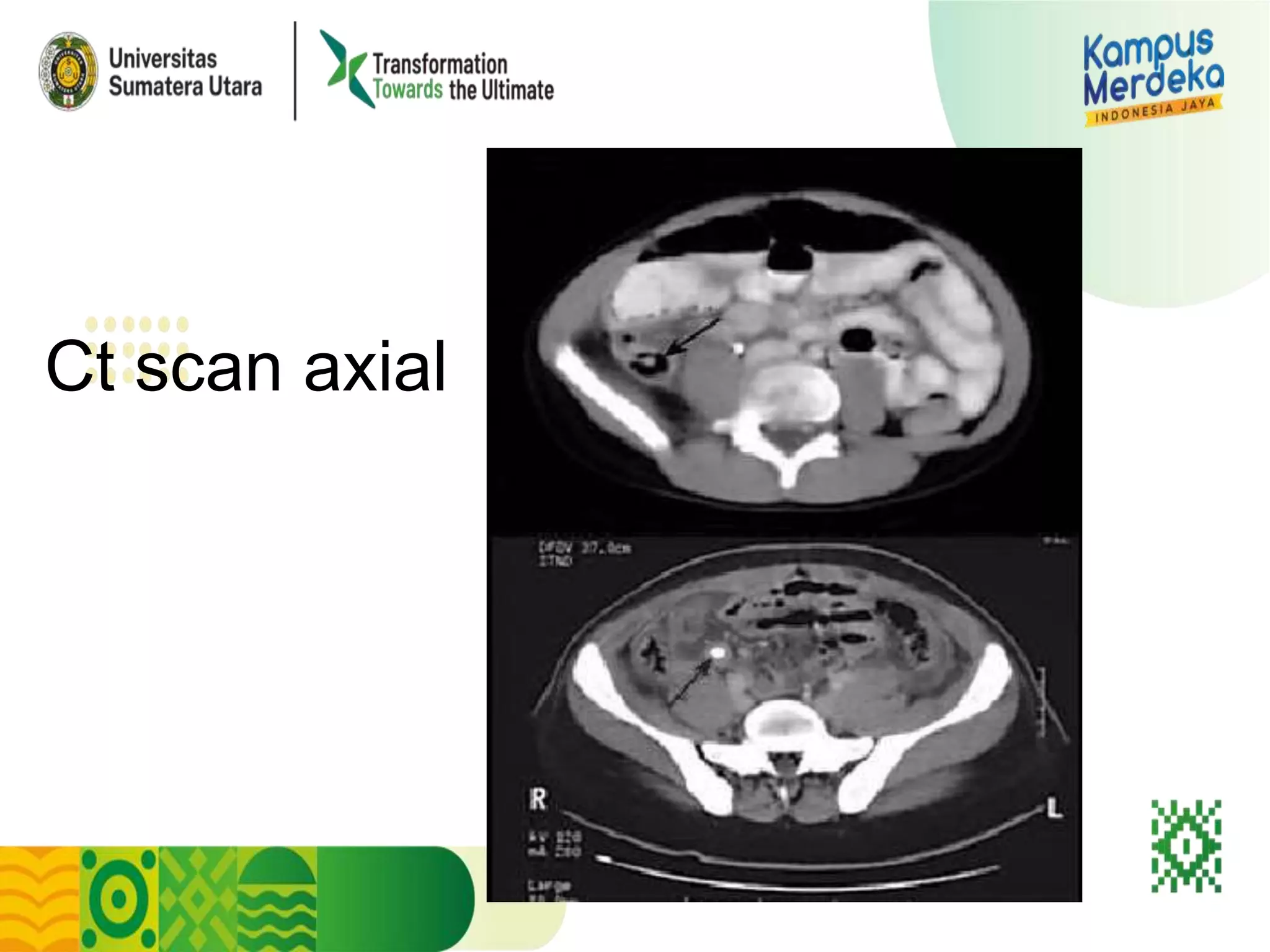 imaging acute appendicitisss.ppt