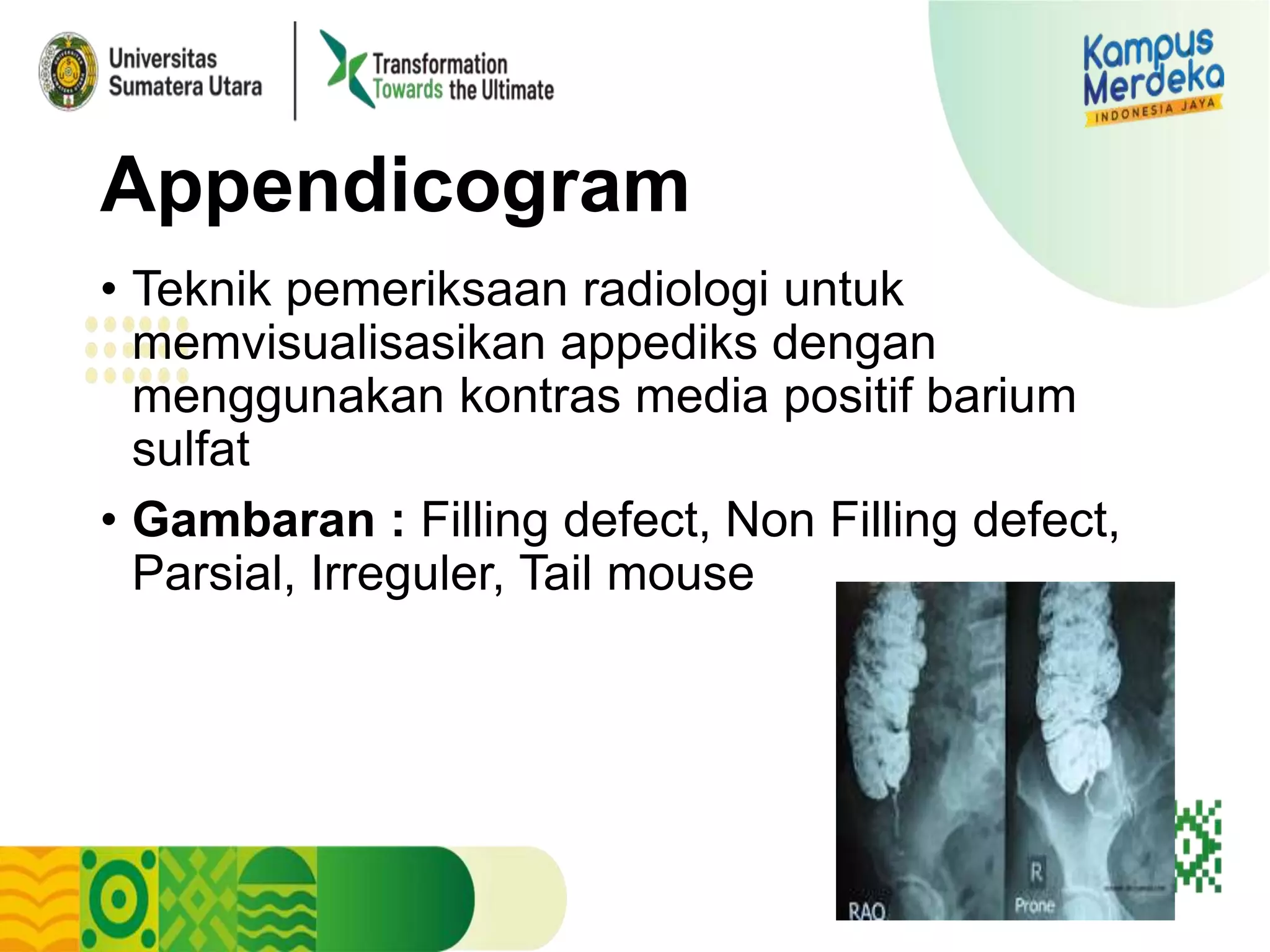 imaging acute appendicitisss.ppt