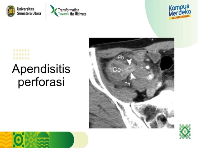 imaging acute appendicitisss.ppt