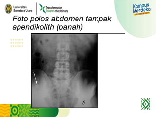 imaging acute appendicitisss.ppt