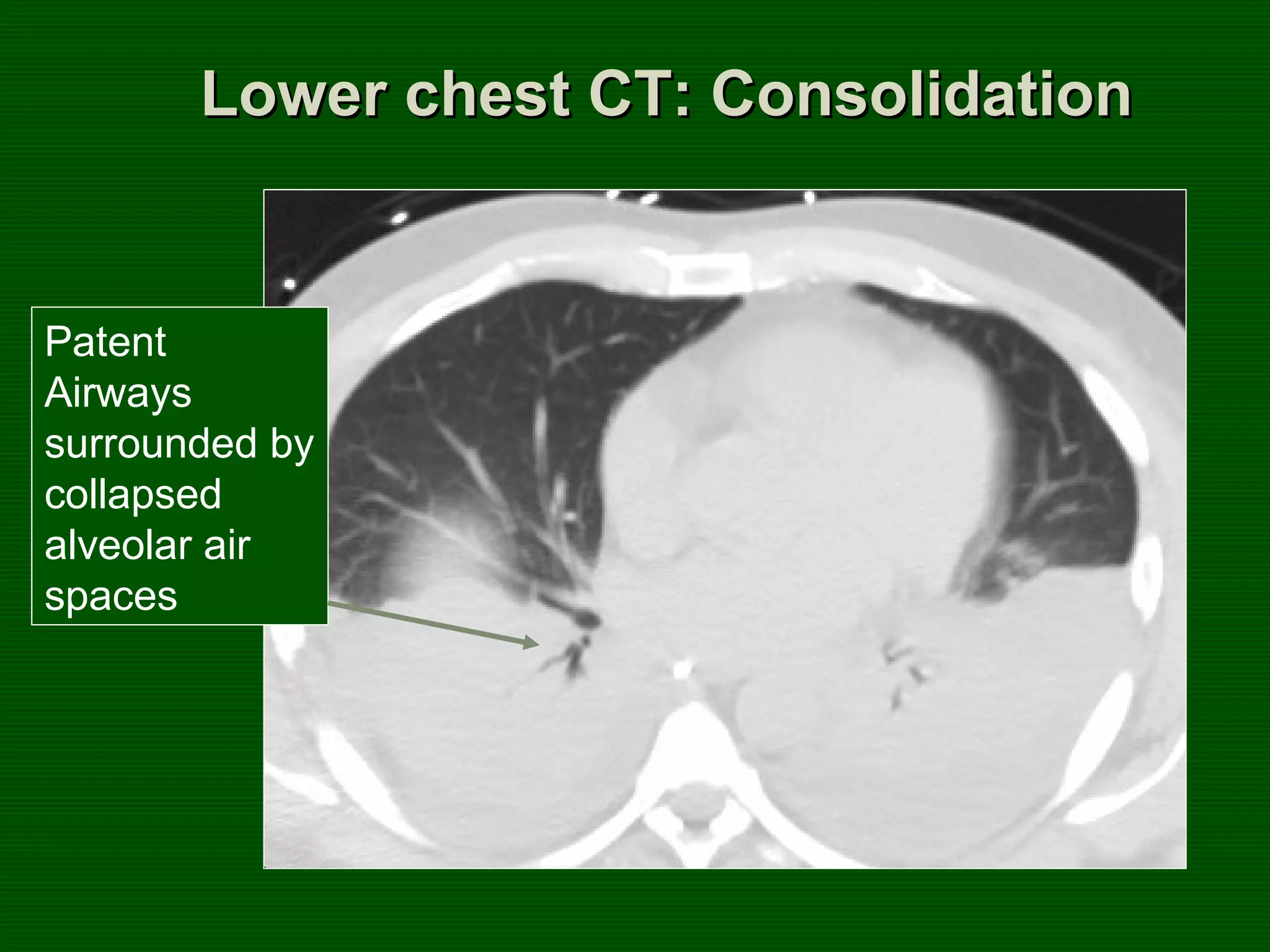 Imaging acute pancreatitis | PPT
