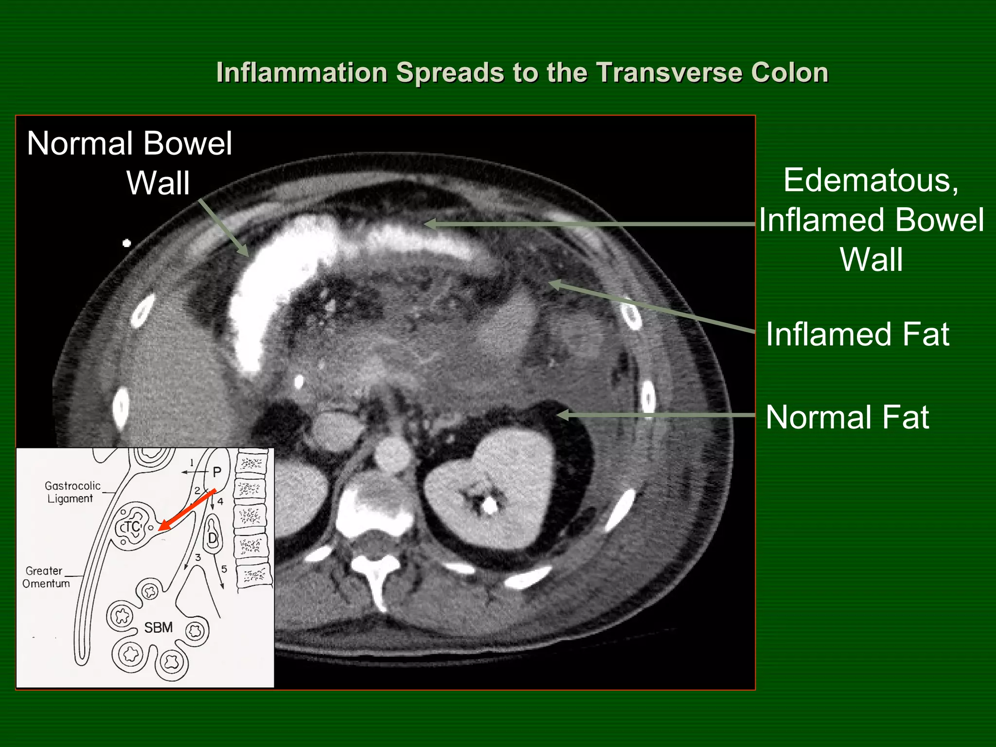 Imaging acute pancreatitis | PPT