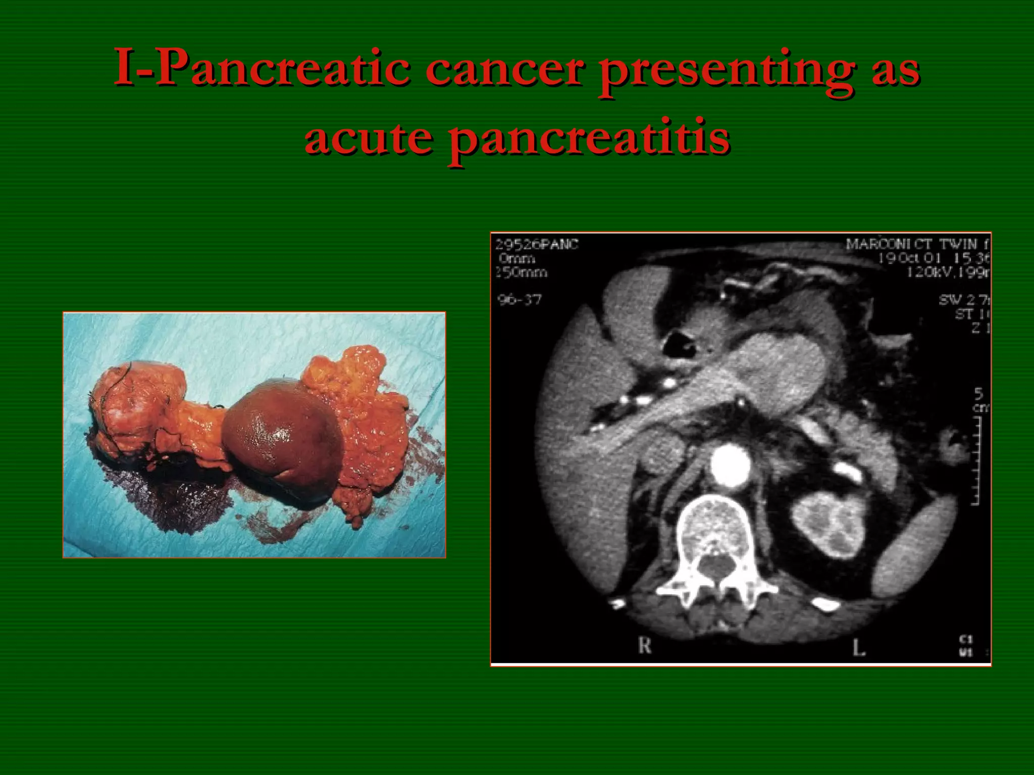 Imaging acute pancreatitis | PPT