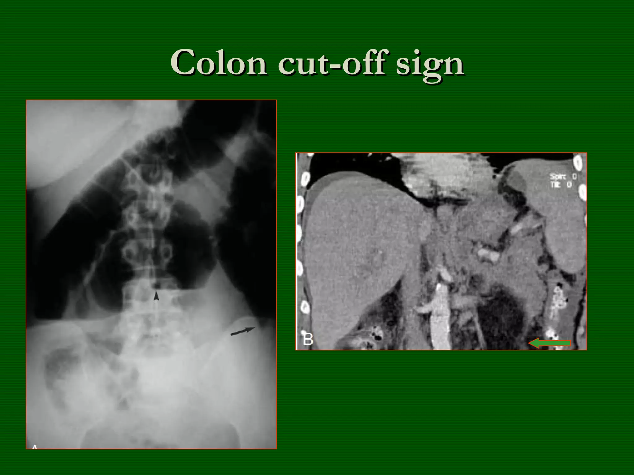 Imaging acute pancreatitis | PPT