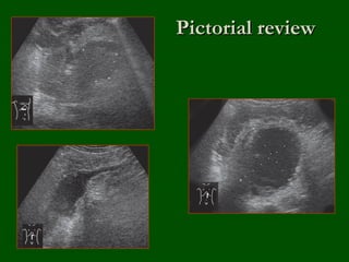 Imaging acute pancreatitis | PPT