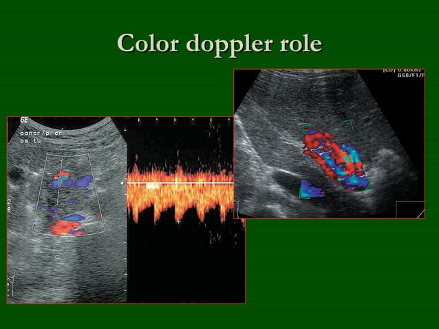 Imaging acute pancreatitis | PPT