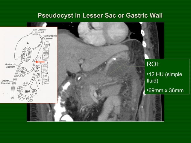 Imaging acute pancreatitis | PPT