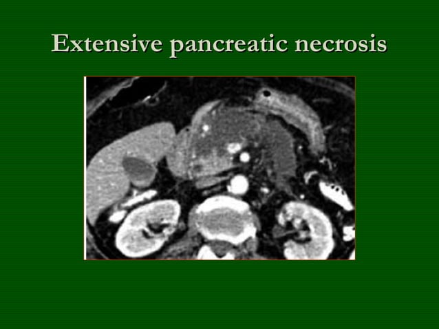 Imaging acute pancreatitis | PPT