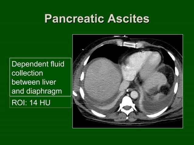 Imaging acute pancreatitis | PPT