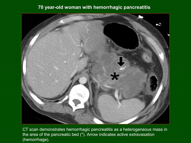 Imaging acute pancreatitis | PPT