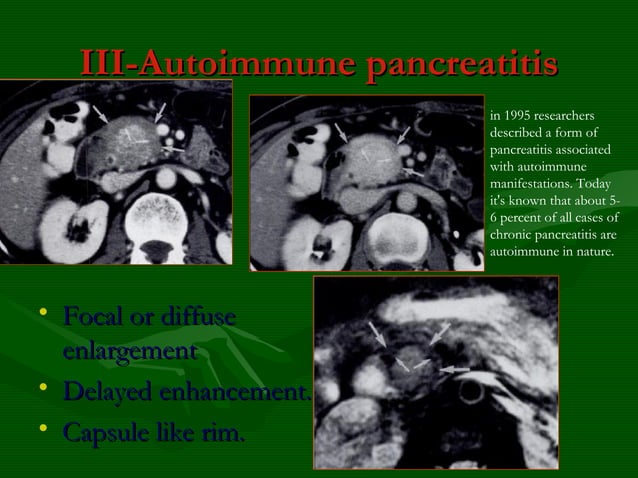 Imaging acute pancreatitis | PPT