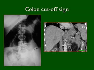 Imaging acute pancreatitis | PPT