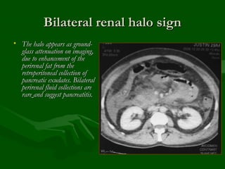 Renal Halo Sign In Acute Pancreatitis