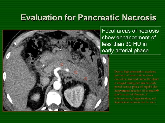 Imaging acute pancreatitis